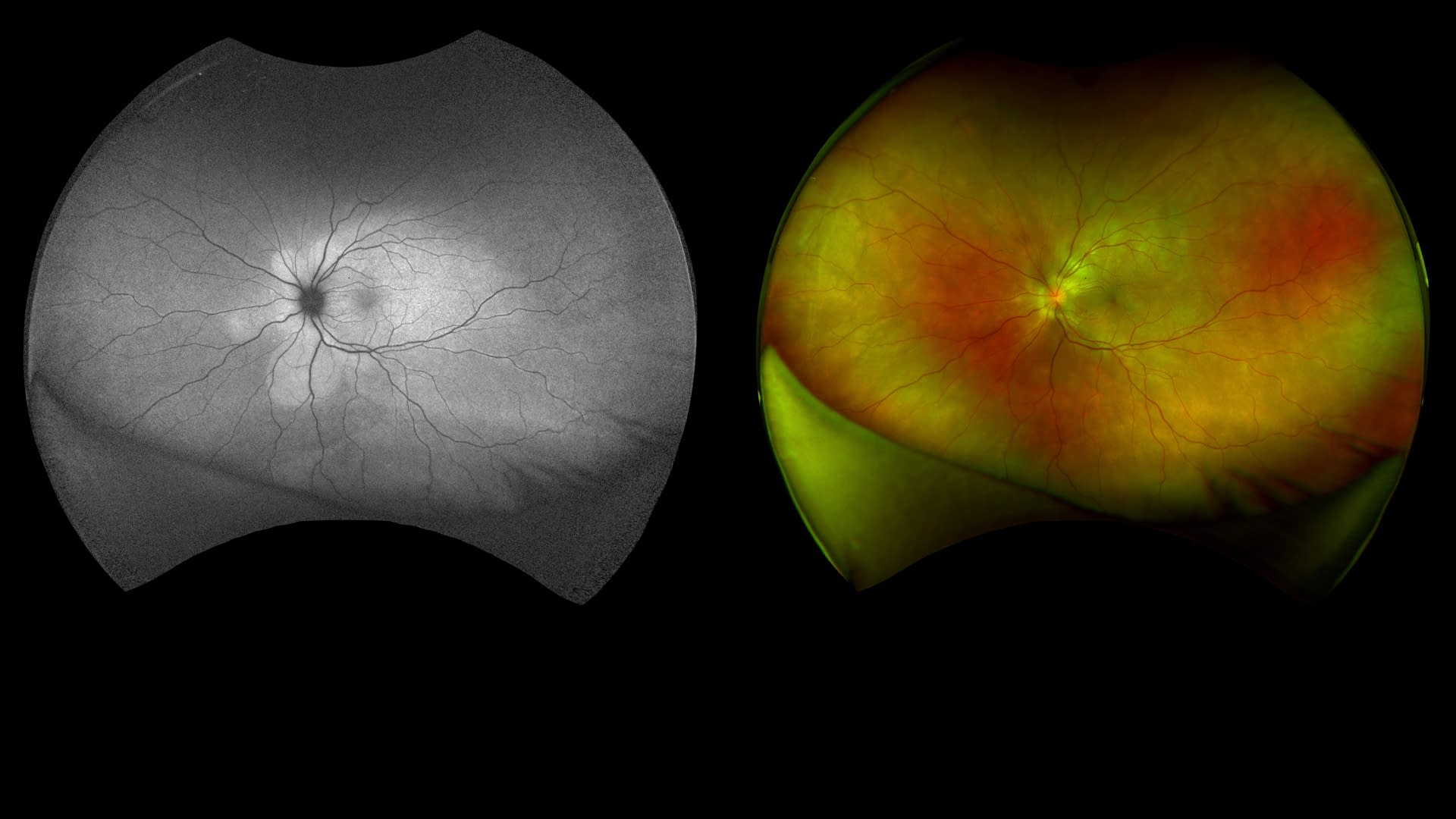 UVEÍTE | Retina Clinic