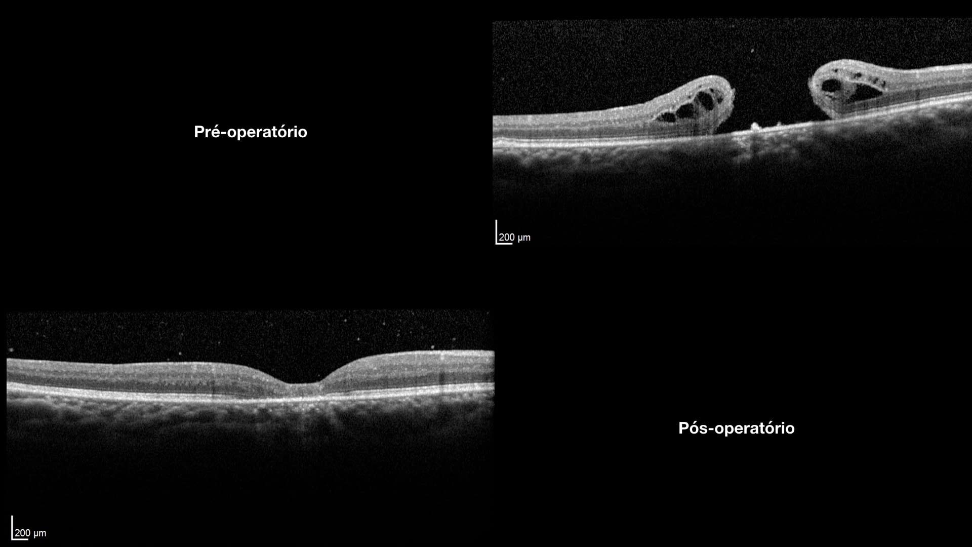 BURACO MACULAR | Retina Clinic