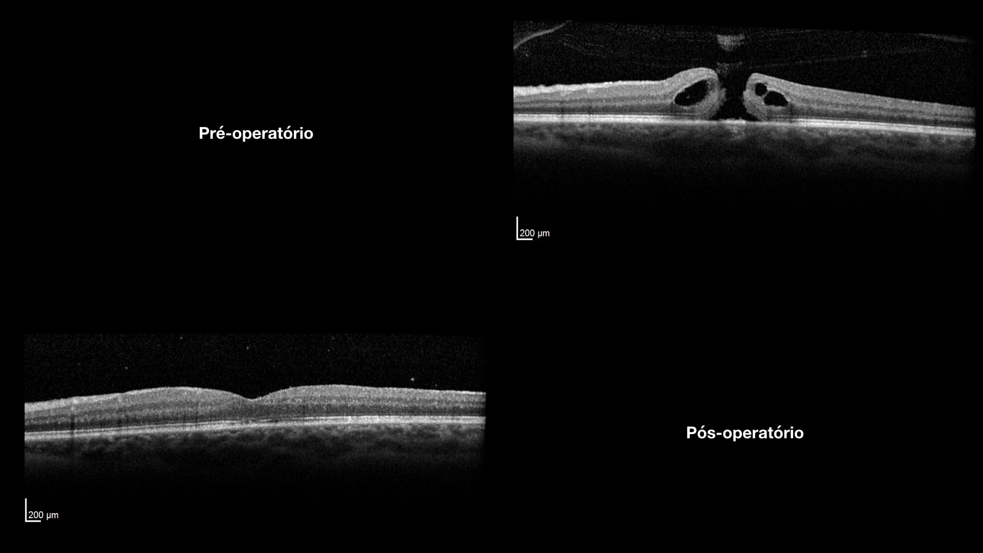 BURACO MACULAR | Retina Clinic