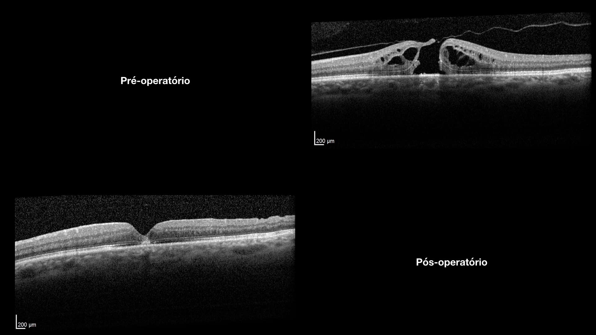 BURACO MACULAR | Retina Clinic