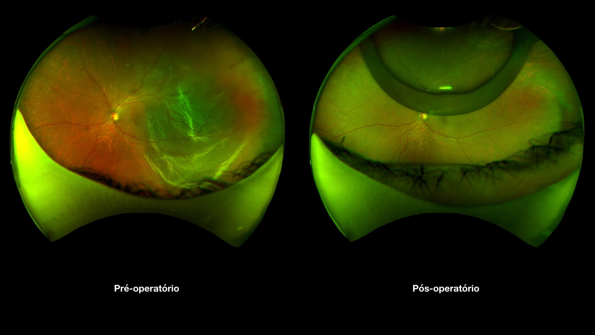DESCOLAMENTO DE RETINA | Retina Clinic