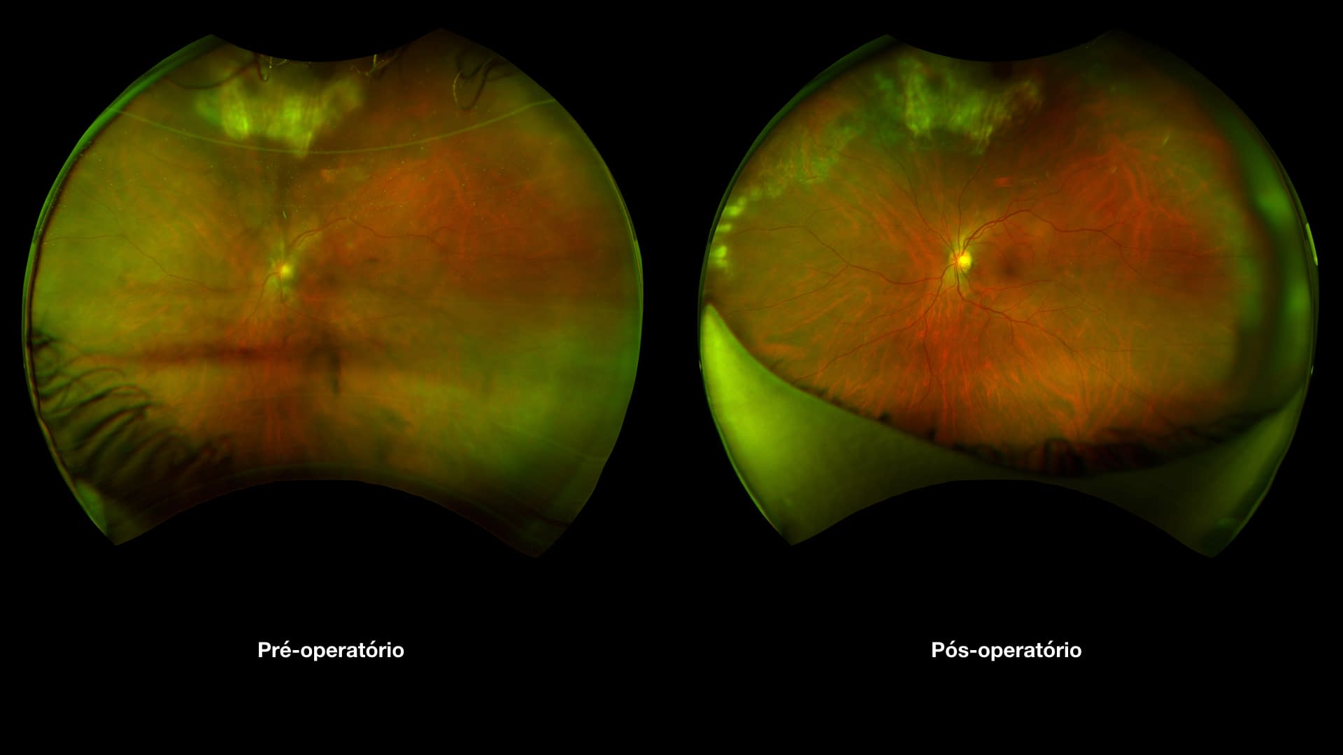 UVEÍTE | Retina Clinic