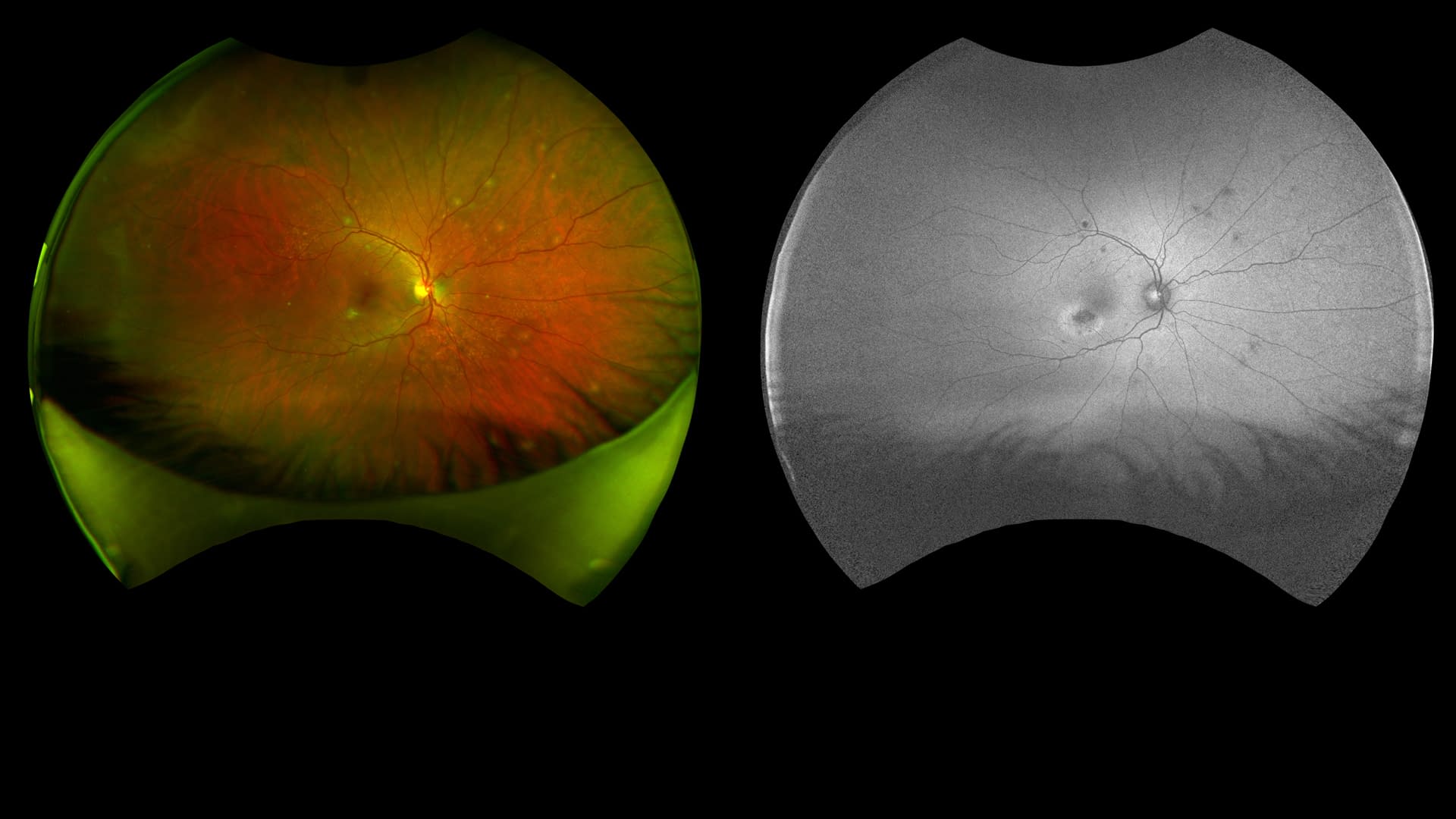 UVEÍTE | Retina Clinic