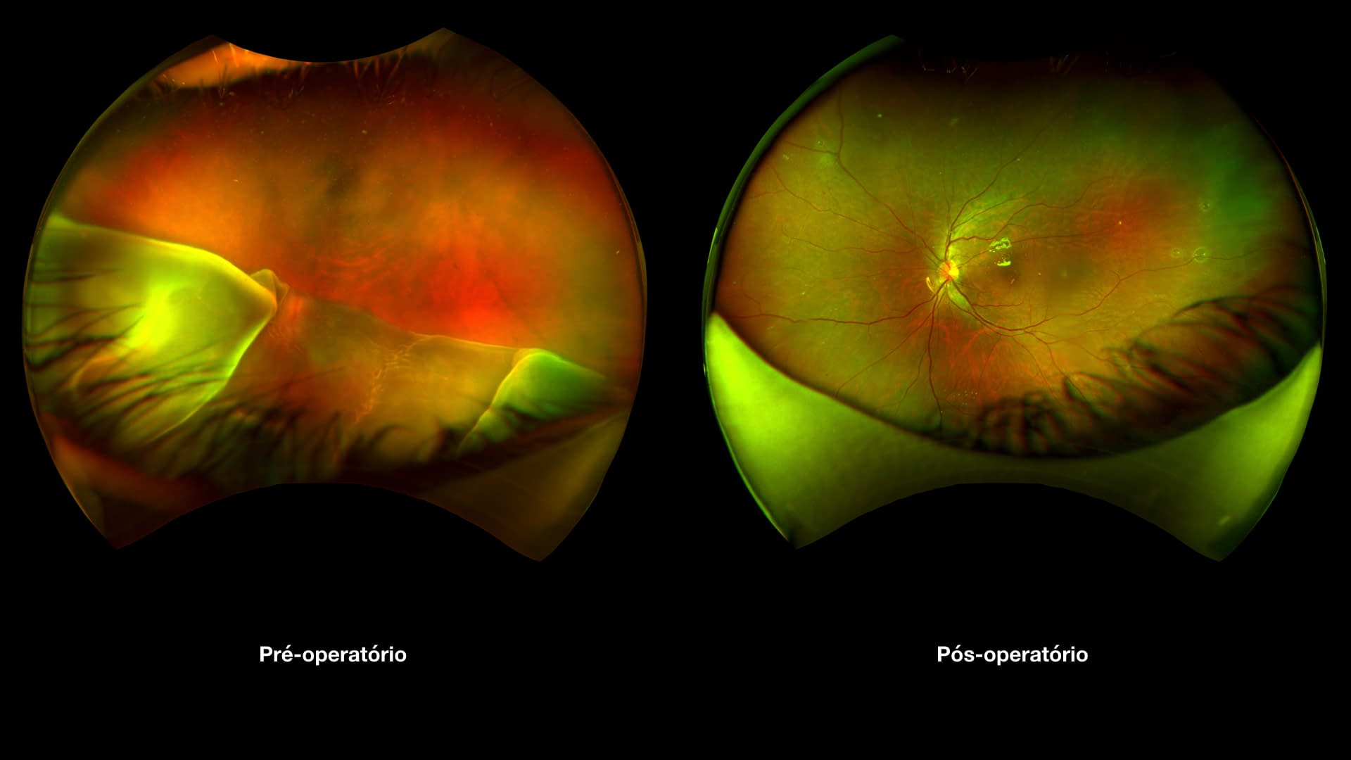 DESCOLAMENTO DE RETINA | Retina Clinic