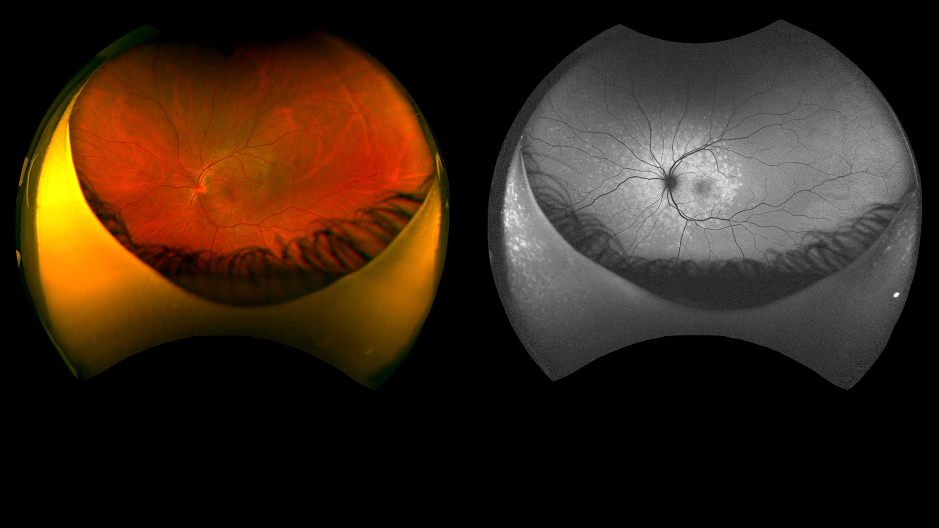 UVEÍTE | Retina Clinic