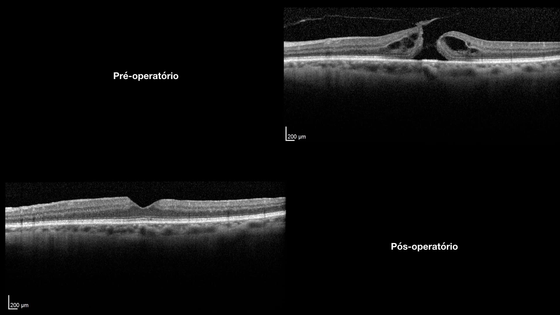 BURACO MACULAR | Retina Clinic