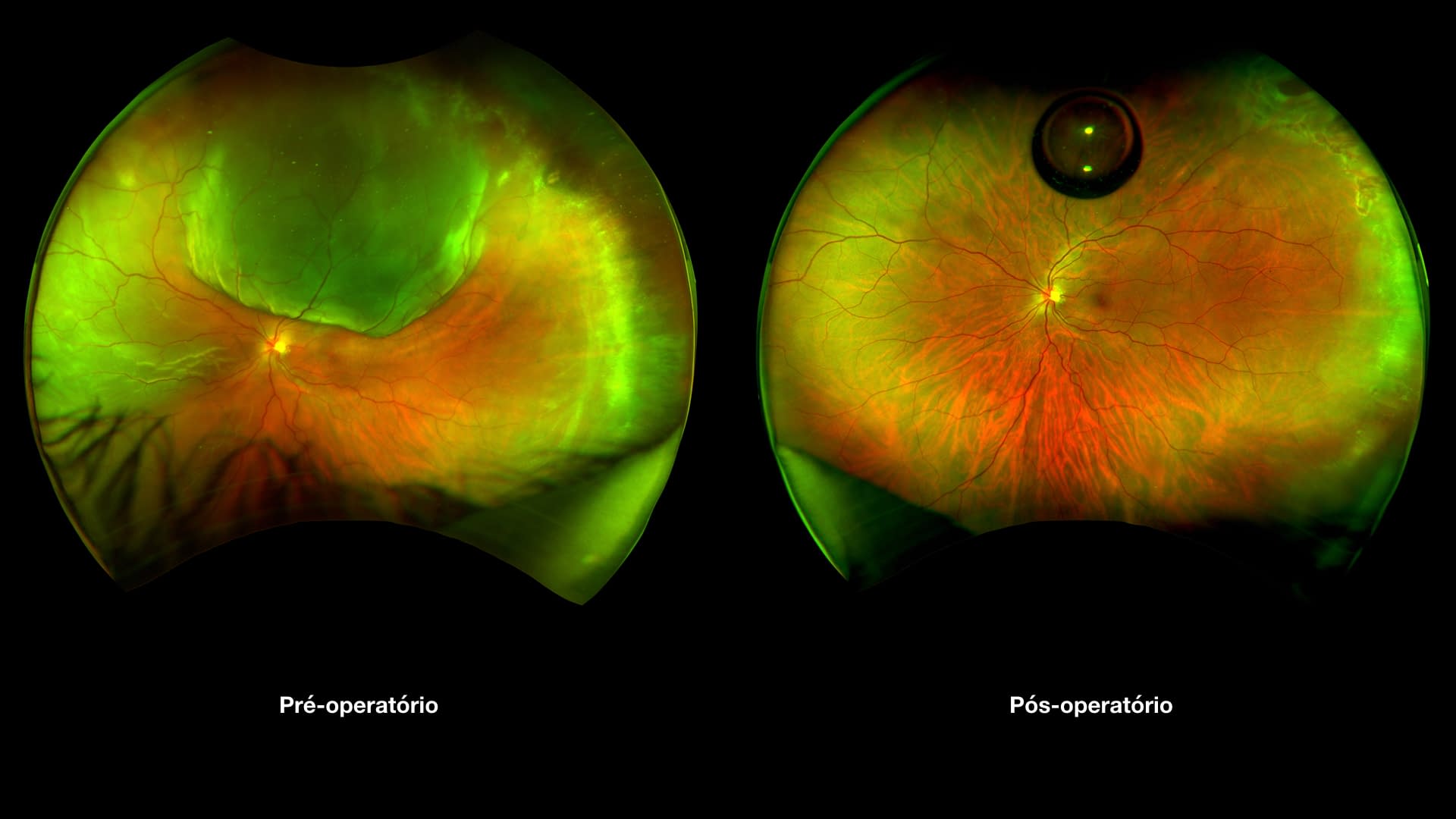 DESCOLAMENTO DE RETINA | Retina Clinic