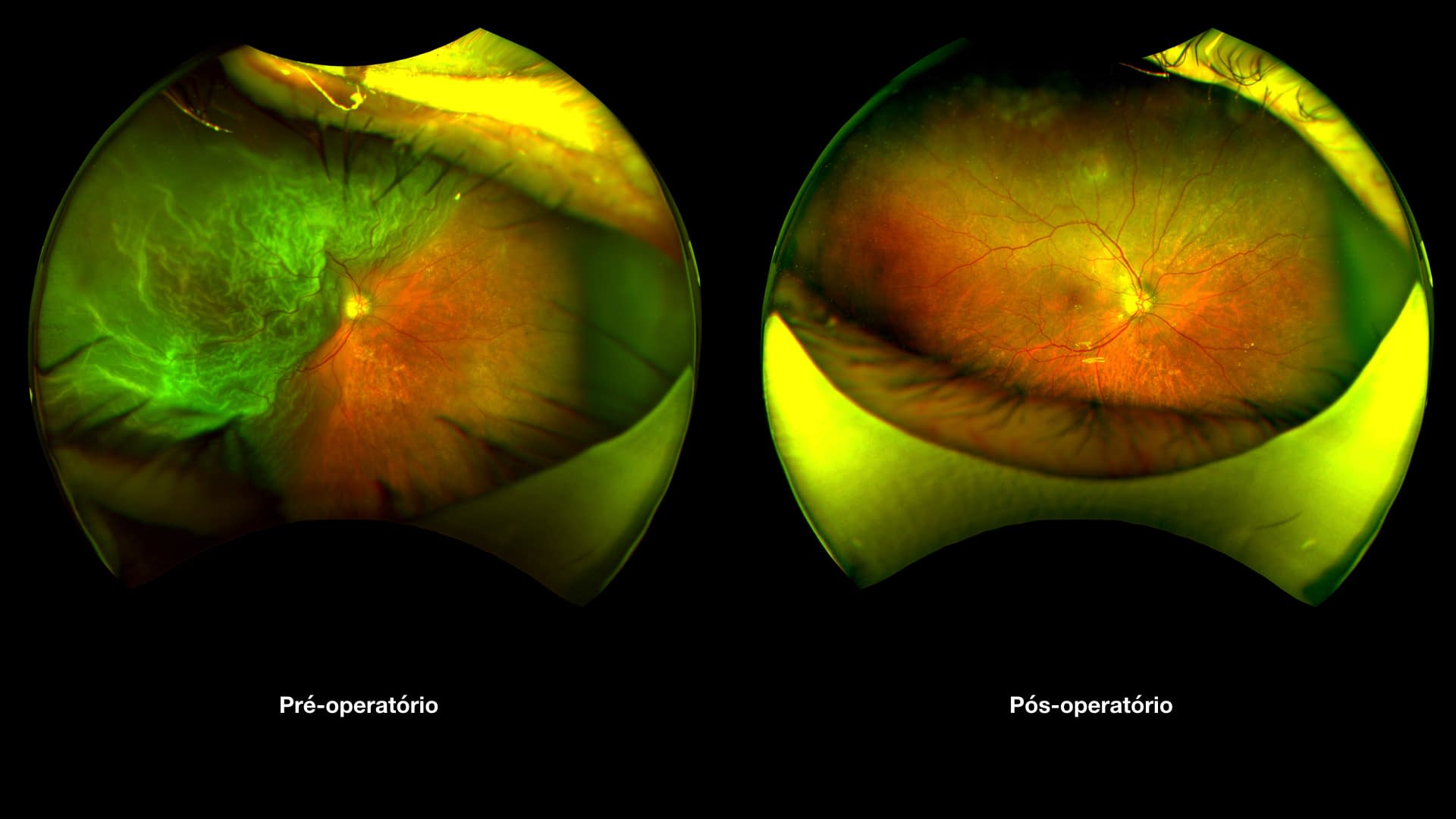 DESCOLAMENTO DE RETINA | Retina Clinic